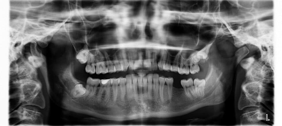 What Are Some of the Dangers of a Misaligned Bite? - Sencak Orthodontics