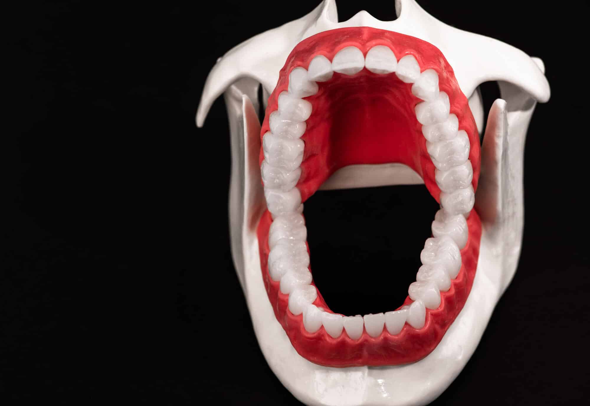 Palate Expander for Adults: Your FAQs Questions Answered